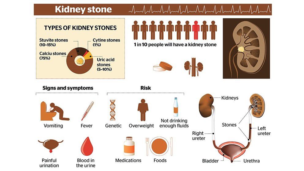 Kidney stones detection and prevention...