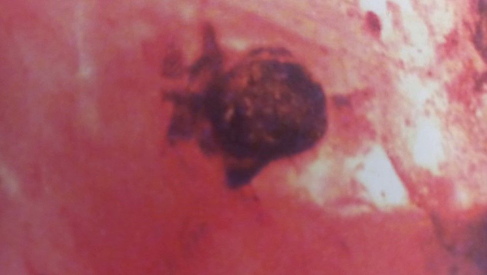 Discovery of the Oldest Tick in the World in Jordanian Amber,
